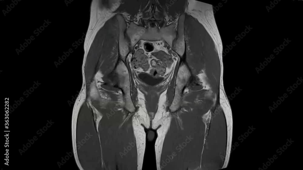 Osteonecrosis Of Hip