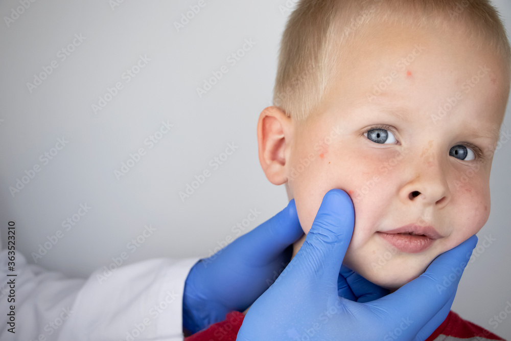 An allergist or dermatologist examines red spots on a child’s face. The ...