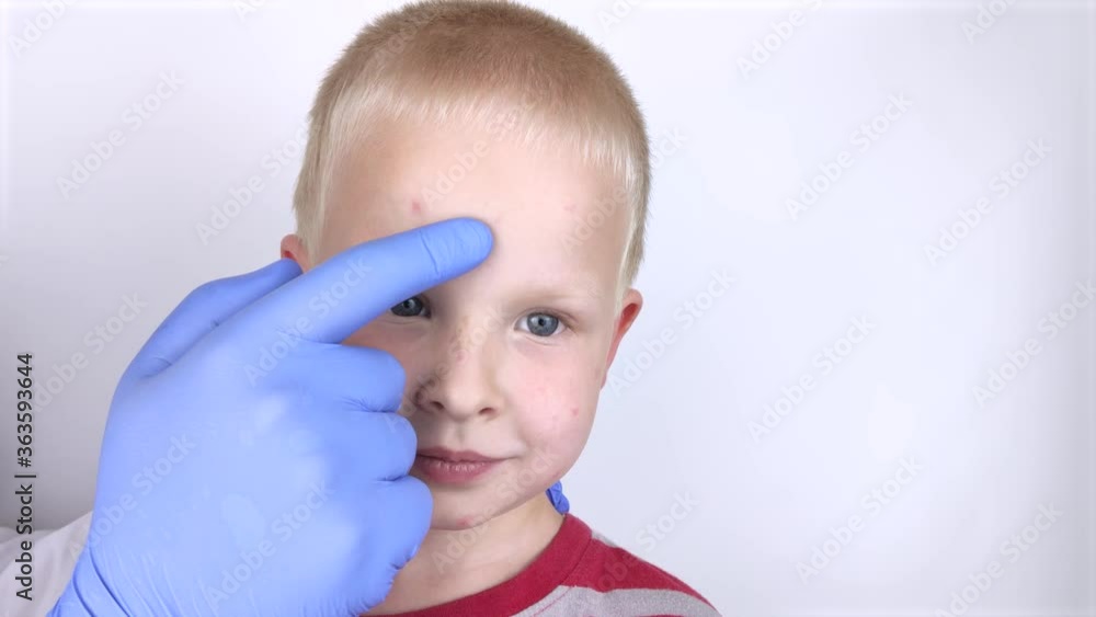 An allergist or dermatologist examines red spots on a child’s face. The ...