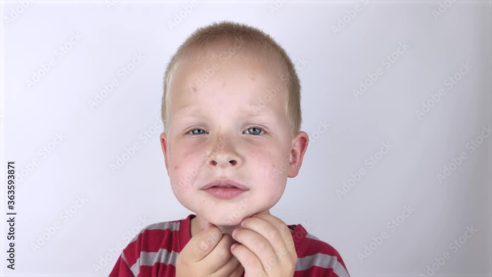 An allergist or dermatologist examines red spots on a child’s face. The ...