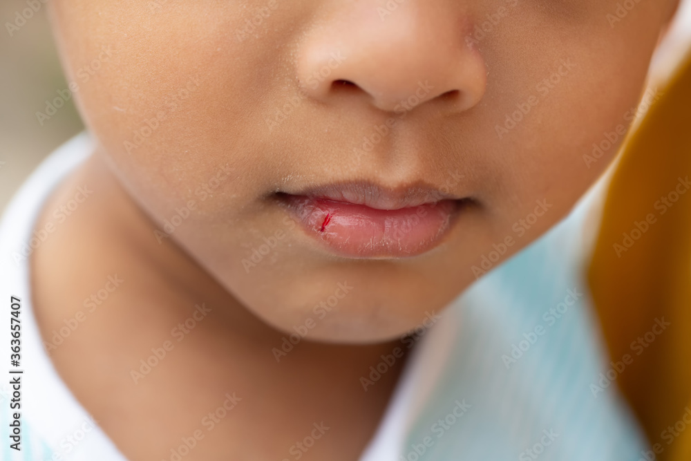 Cracked lips of child. The bleeding and swollen lip of a little boy ...