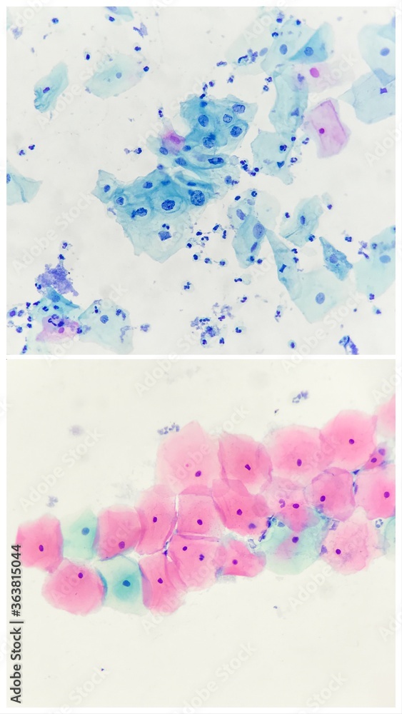 Photo of PAP smear. It shows low-grade squamous Intraepithelial lesion ...