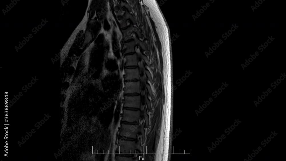 MRI spine scan, magnetic resonance imaging of a back and skeleton close ...