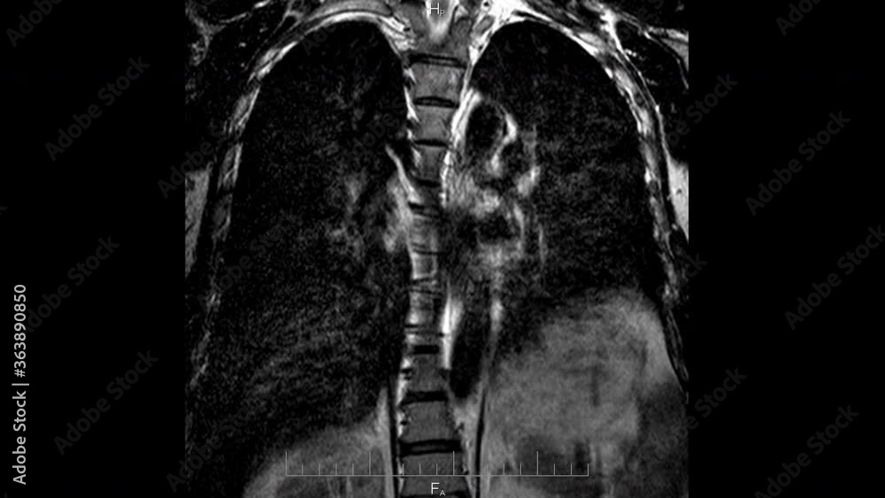 MRI spine and lung scan, magnetic resonance imaging of a back and ...