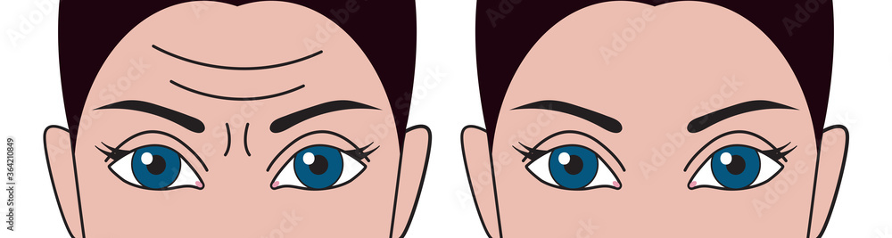 Wrinkles on womans forehead Stock Vector | Adobe Stock