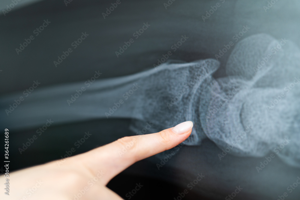 X-ray of a broken arm. The doctor at the hospital points to the ...