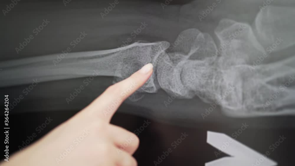 X-rays of a fractured radial bone with displacement. The doctor is ...