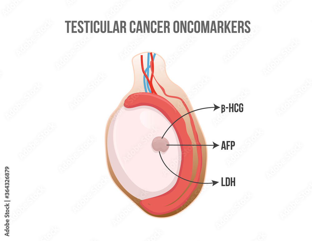 Testis Tumor Markers Testicular Cancer Releasing Hormones And Enzymes
