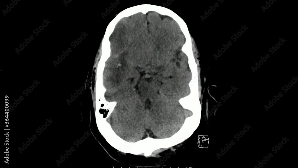 Computed tomography scan of the brain axial cuts showing massive right ...