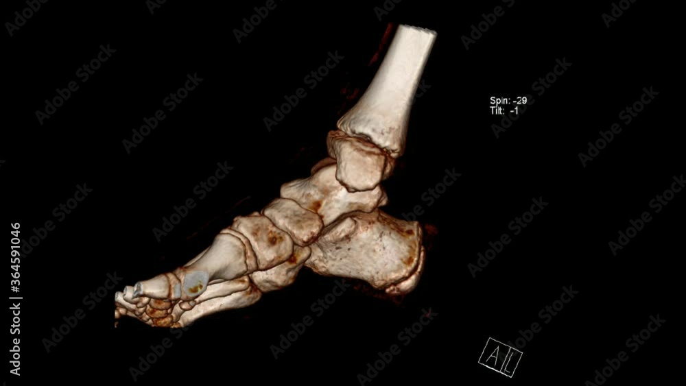 Computed Tomography volume rendering (CT VR) footage of fracture of the ...
