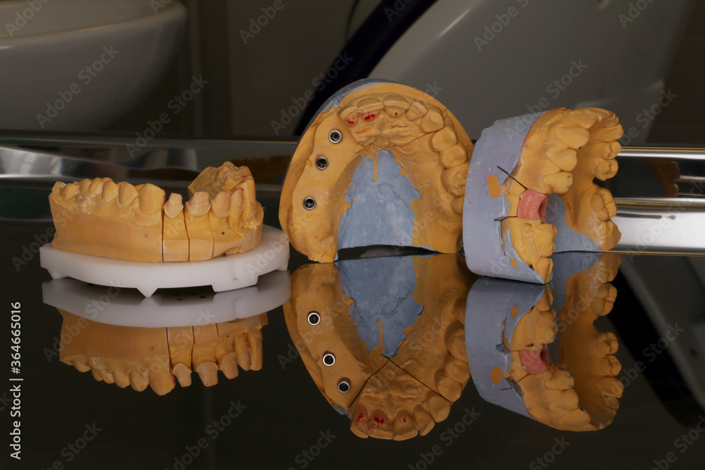 Laboratory gypsum models with artificial gums and implants. Different ...