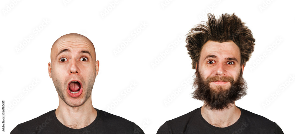 bald man before and after transplant hair and alopecia. Isolated on ...