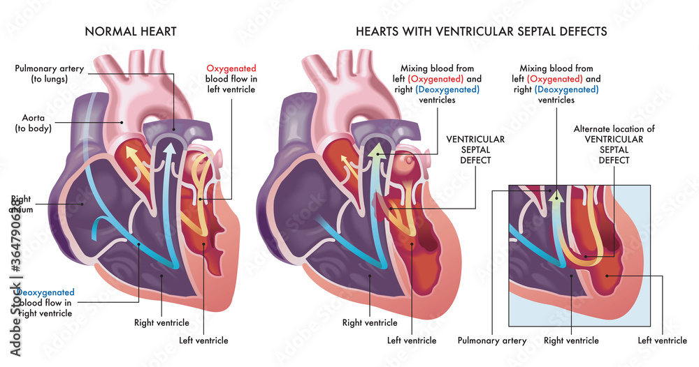 Medical illustration that compares a normal heart with hearts afflicted ...