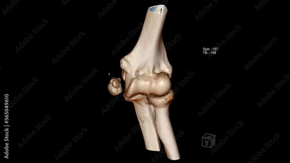 Radiology examination, Computed Tomography Volume Rendering examination ...