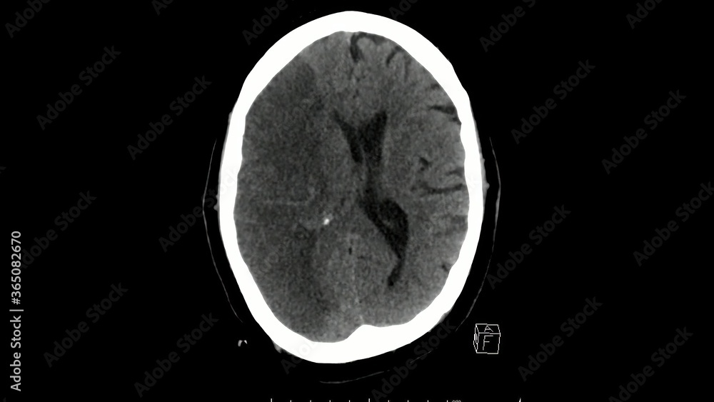 Computed tomography scan of the brain axial cut showing massive right ...