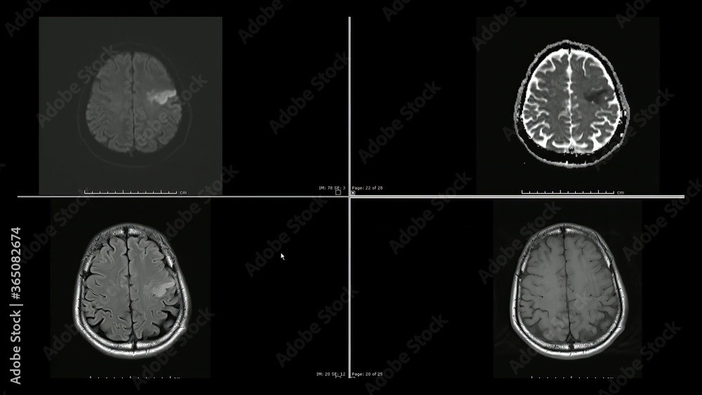 Magnetic resonance images (MRI) of brain infarction in the left frontal ...
