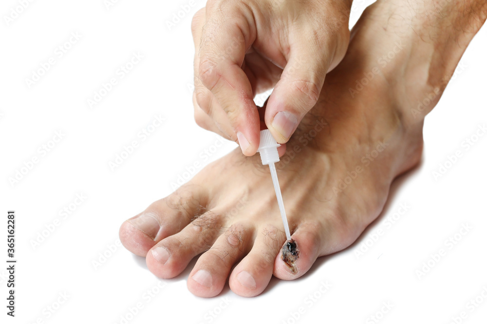 Foto de Wart on finger after treatment by salicylic acid. wart on the ...