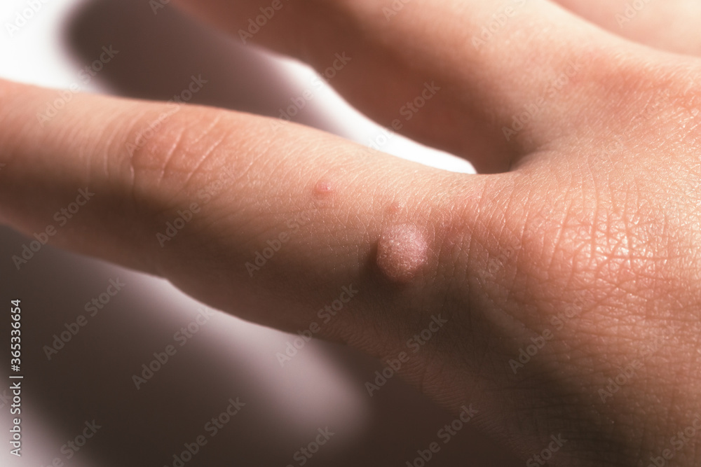 Common wart Verruca vulgaris a flat wart commonly found on the hand of ...