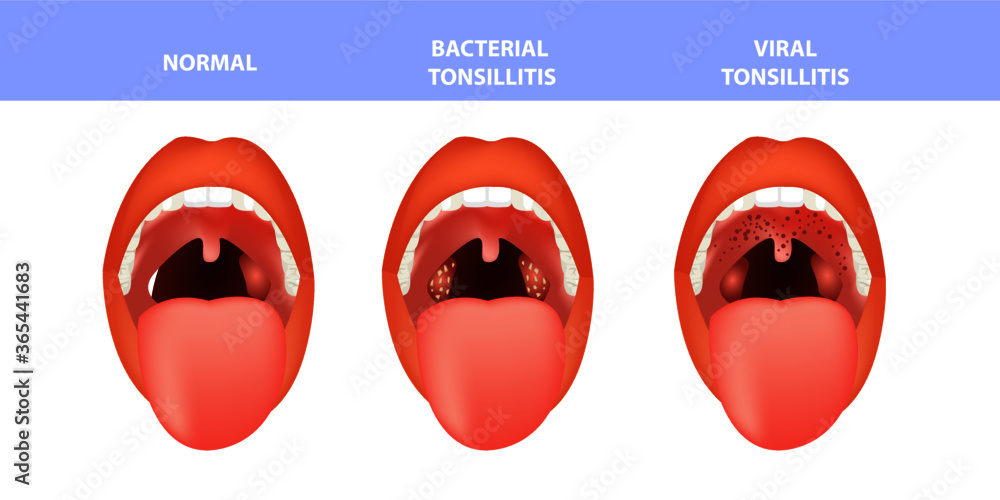 Open mouth, normal and Tonsillitis bacterial and viral. Angina ...