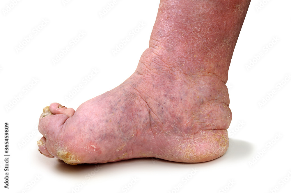 Patients feet of an old man.Inflammatory process.Gout.Erysipelas.Nail ...