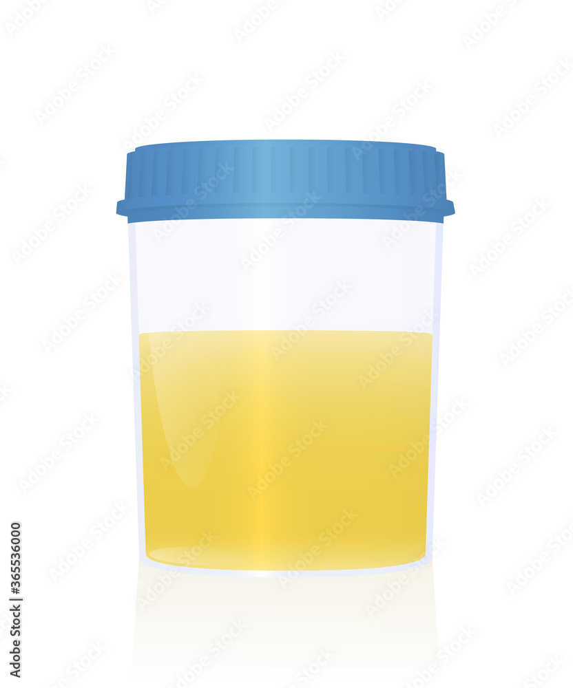 Urine sample in a specimen cup with blue cap for urological analysis ...