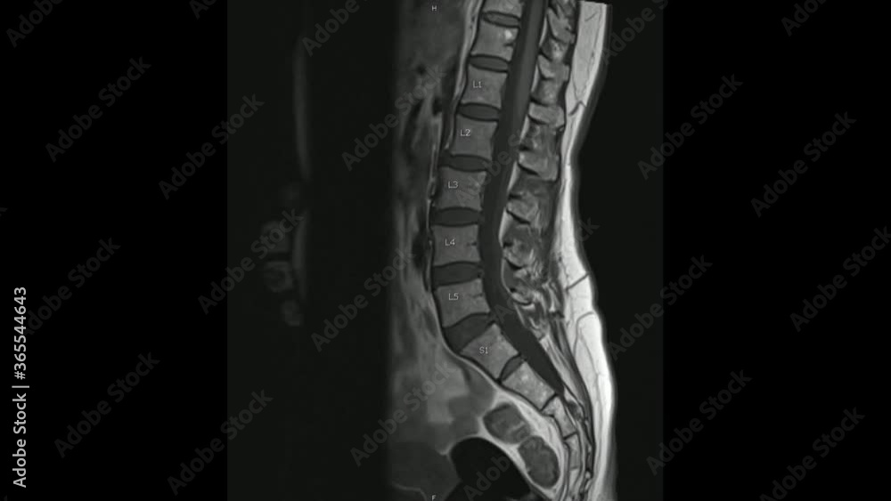 Magnetic Resonance images of Lumbosacral spine sagittal T1-weighted ...