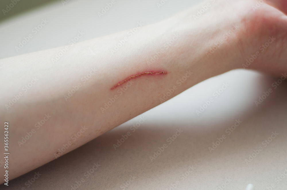 Hand with a cut, wound treatment, medical instruments for a wound Stock ...