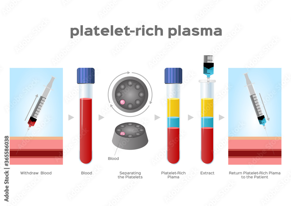 Platelet-Rich plasma procedure stages / prp / Centrifuge vector Stock ...