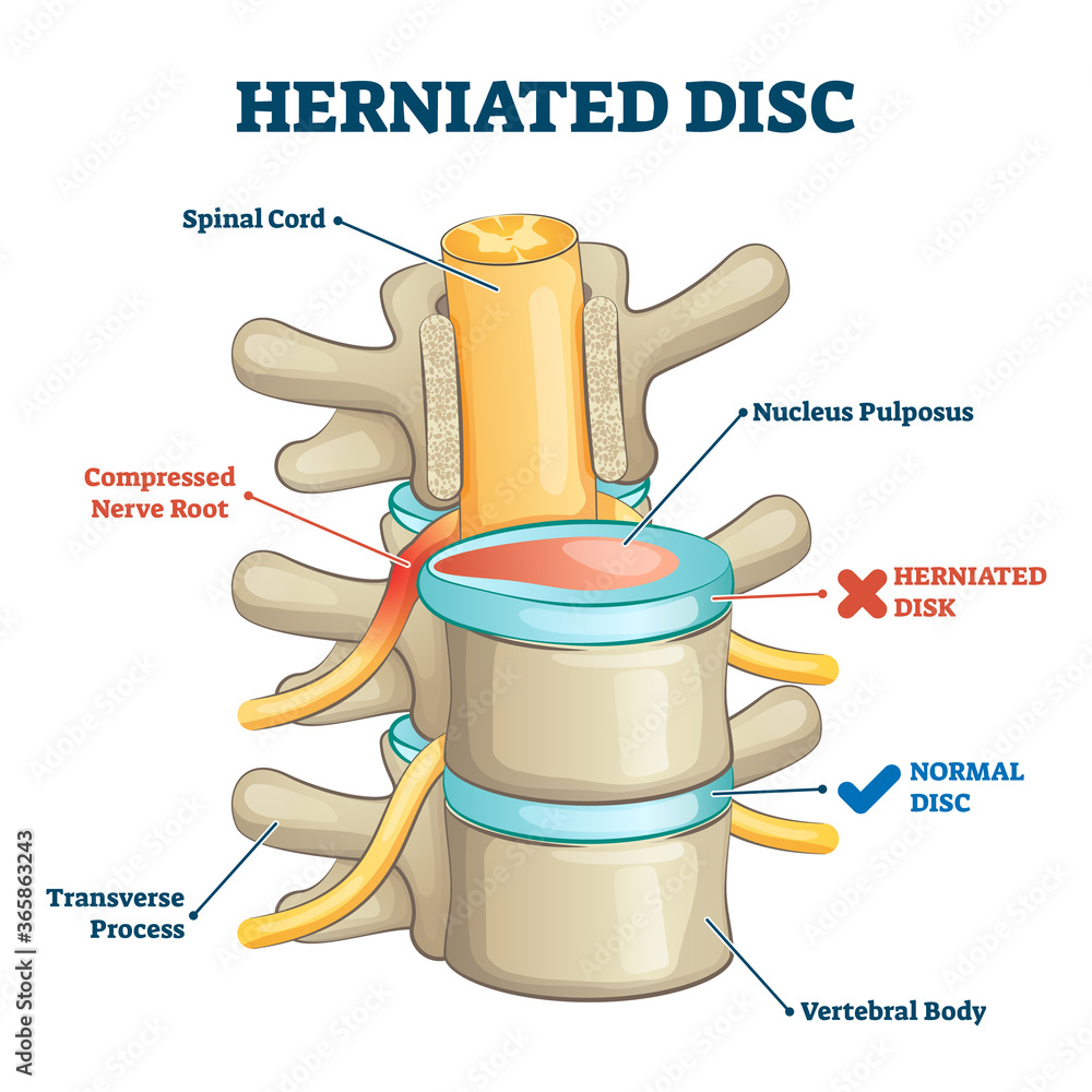 Herniated disc injury 3D side view on spine bone skeleton vector ...