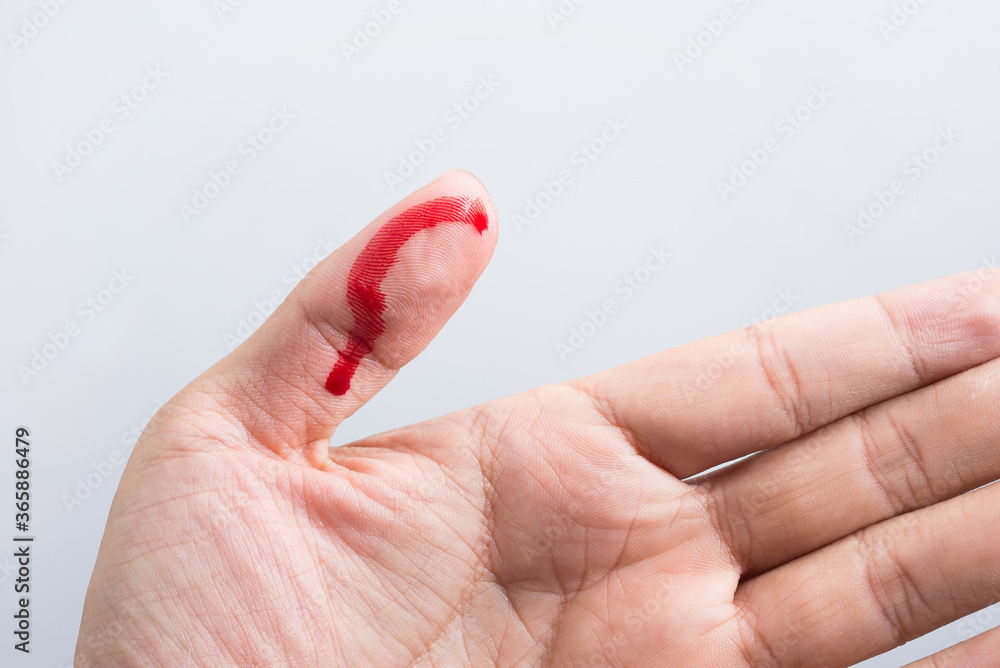 Bleeding blood from the cut finger wound. Injured finger with bleeding ...