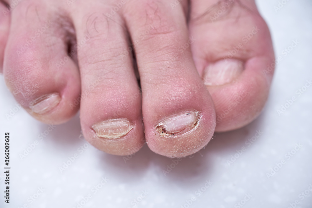 Male nails destroyed by onycholysis. Damage to the male foot nails. At ...
