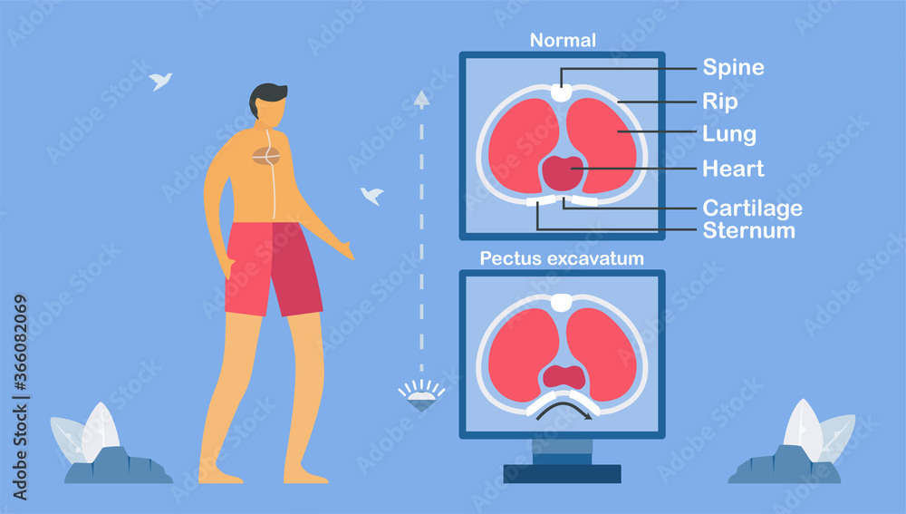 Pectus excavatum is a structural deformity of anterior thoracic wall ...