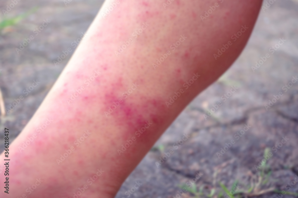 Blurred images for dermatitis, viral dermatitis rash dermatitis of ...