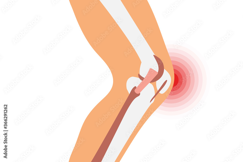 Joint pain illustration. Bone pain. Ache. Arthritis. Orthopedic medical ...