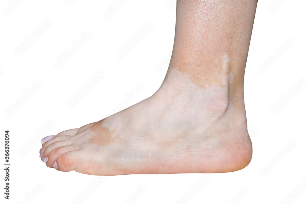 Stains from vitiligo disease on the left foot in a young Caucasian ...