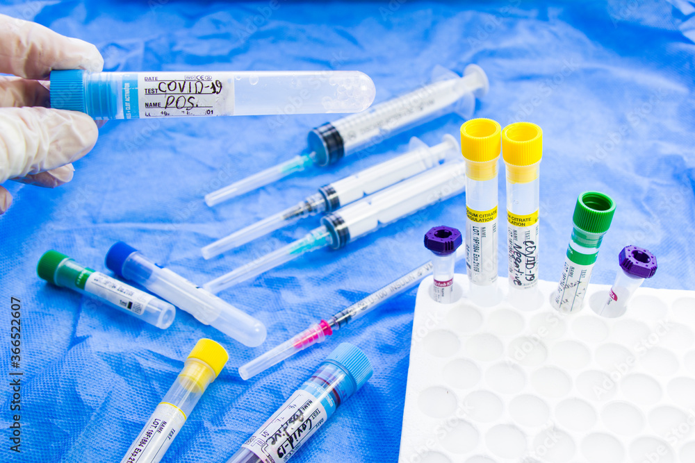 Corona virus and Covid-19 positive test samples. Diagnosis and ...