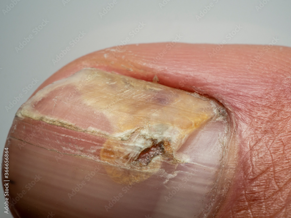 Nail infections caused by fungi such as: onychomycosis also known as ...