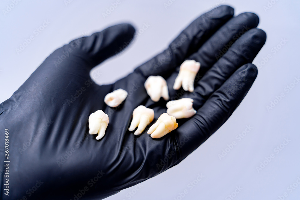 Artificial teeth in the dentist's hand. Ceramic dental implants. Model ...