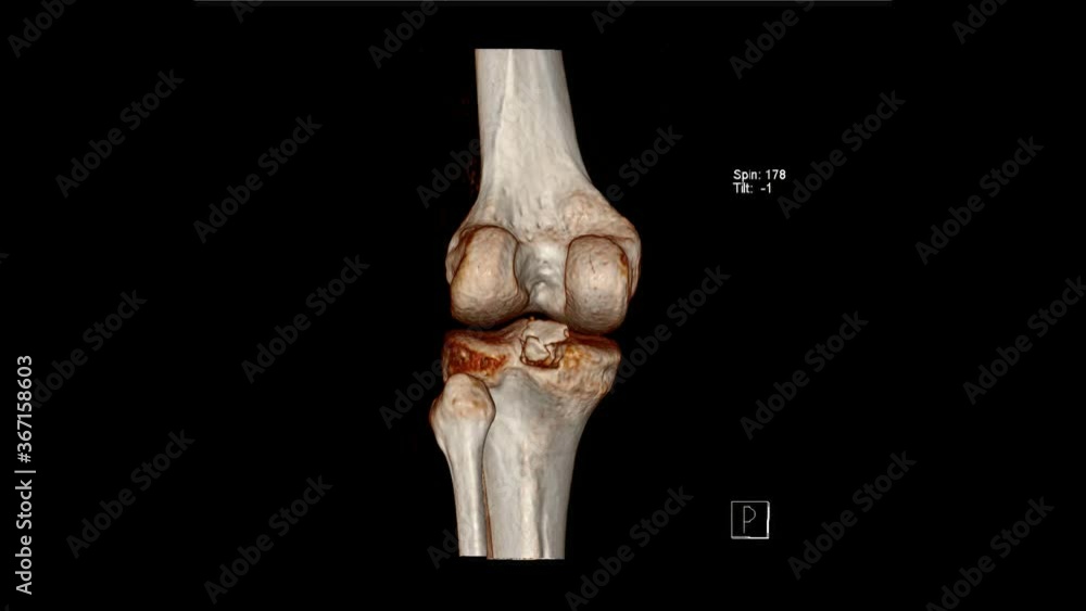 Radiology examination, Computed Tomography Volume Rendering examination ...