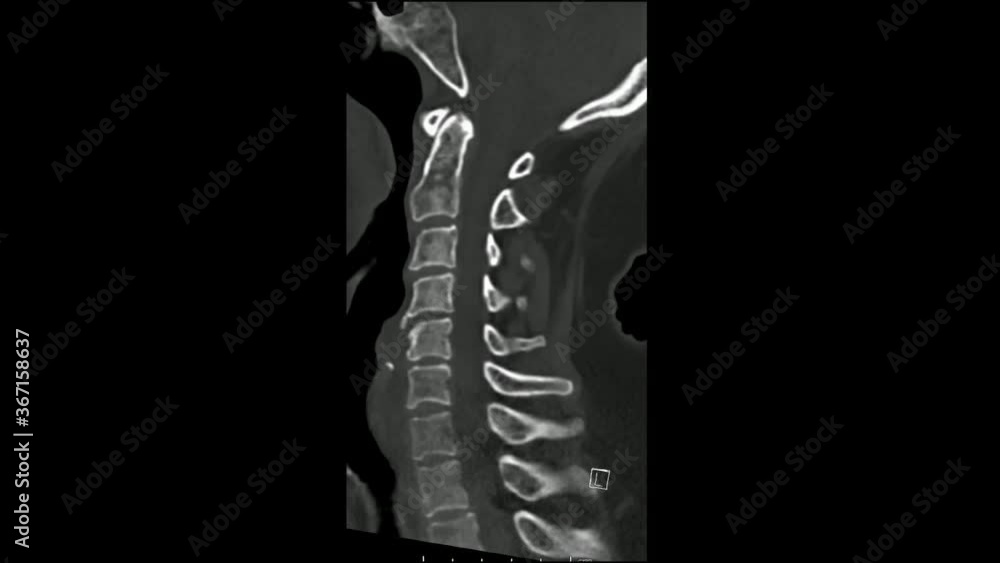 Radiology examination, Computed Tomography examination of the Cervical ...