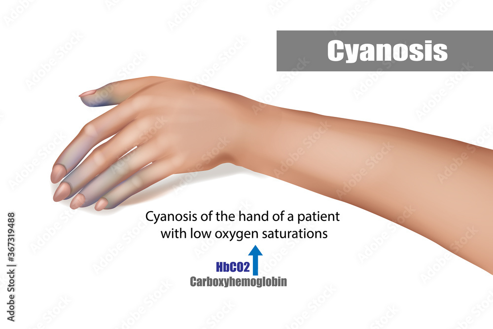 Cyanosis of the hand of a patient with low oxygen saturations Stock ...
