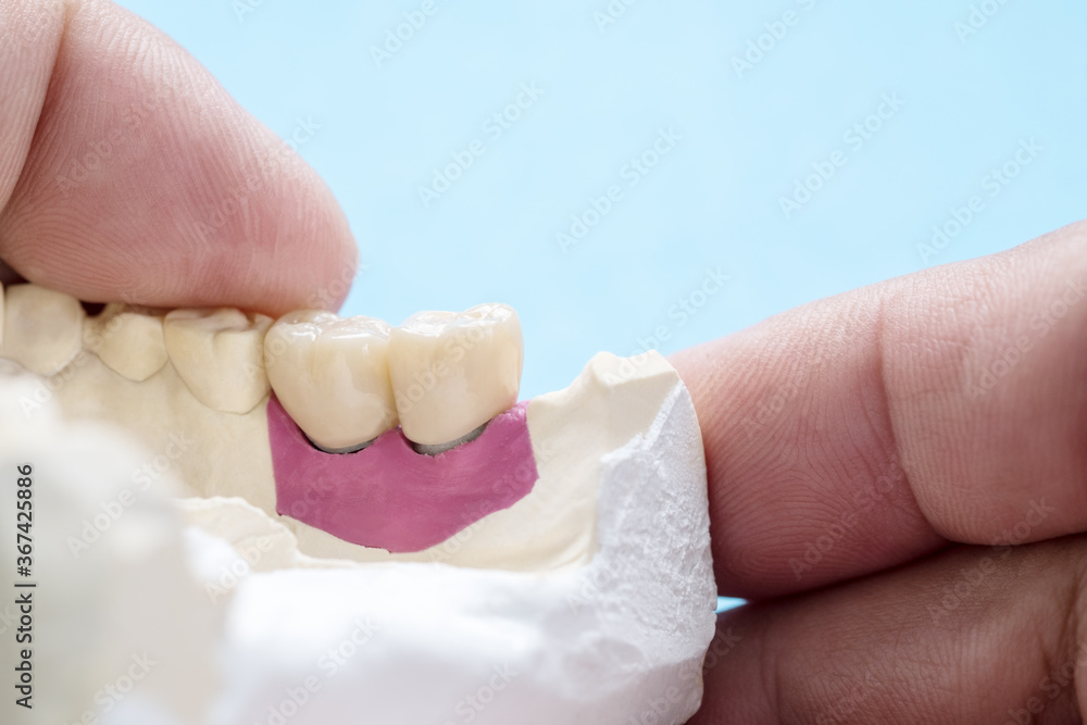Closeup / Implant Prosthodontics or Prosthetic / Tooth crown and bridge ...