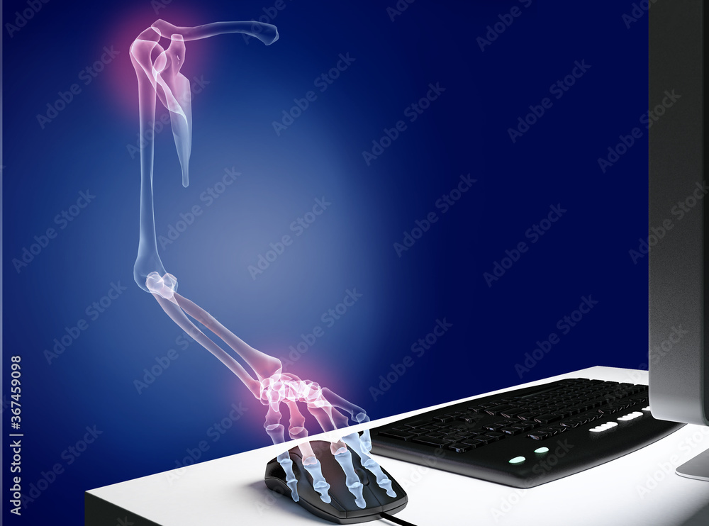 Carpal Tunnel Syndrome,Skeletons and computer, Arms bones on Office ...