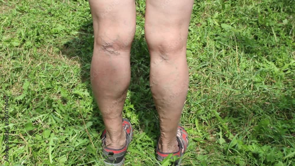 The old age and sick of a woman. Varicose veins on a legs of woman. The ...