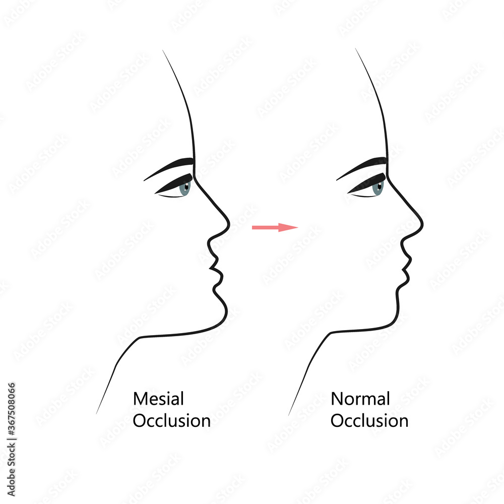Mesial bite profile before and after orthodontic treatment. Human with ...