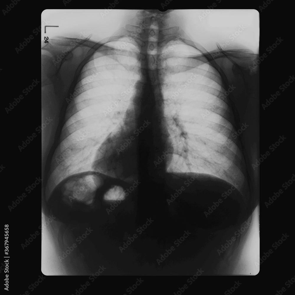 X-ray film of human chest. Radiograph of the lungs of people. Black and ...