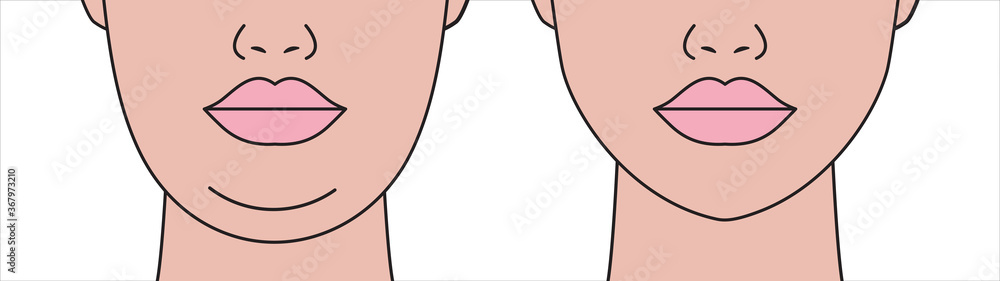 Double chin, restoration of facial contours with aid liposuction Stock ...