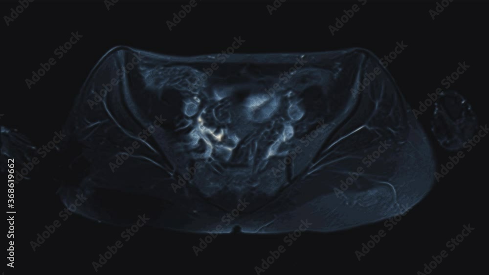 Voluminous color MRI of the female pelvic organs, abdominal cavity ...