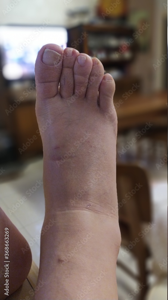 feet of a man, swollen feet, circulation problems Stock Photo | Adobe Stock