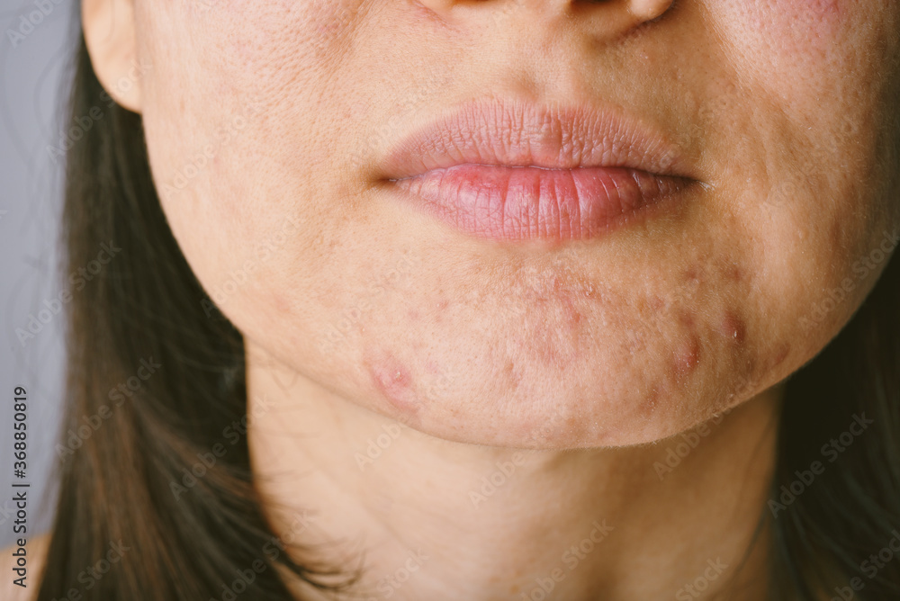 Skin problem with acne diseases, Close up woman face with whitehead ...